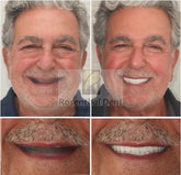 Flexible Nesbit Flipper Denture – 1–3 Tooth Partial | Order Online