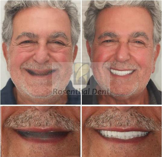 Flexible Nesbit Flipper Denture – 1–3 Tooth Partial | Order Online