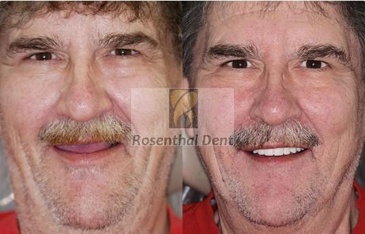 Flexible Nesbit Flipper Denture – 1–3 Tooth Partial | Order Online