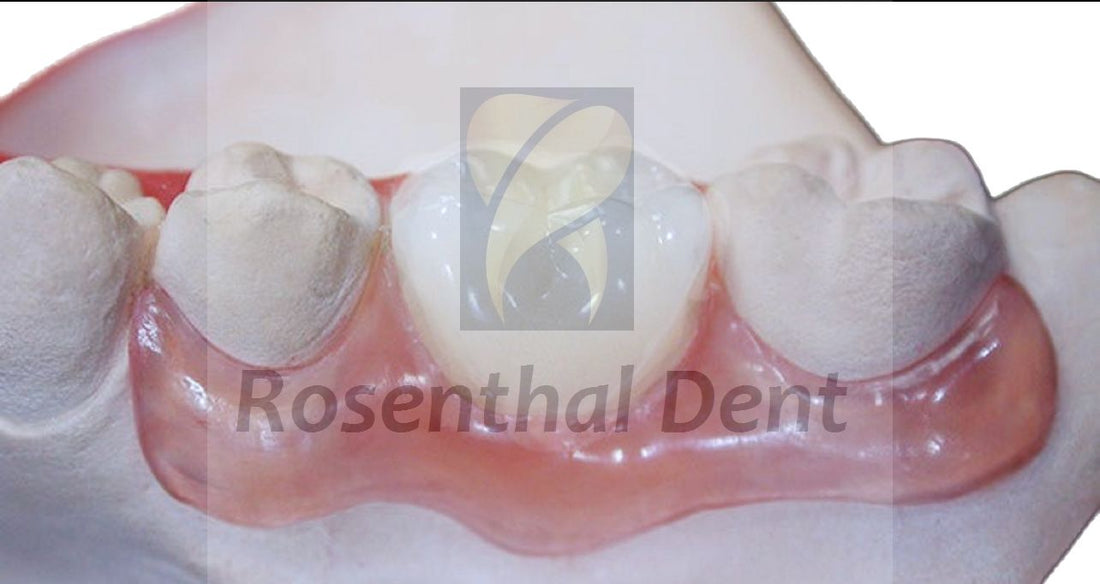 Flexible Nesbit Flipper Denture – 1–3 Tooth Partial | Order Online